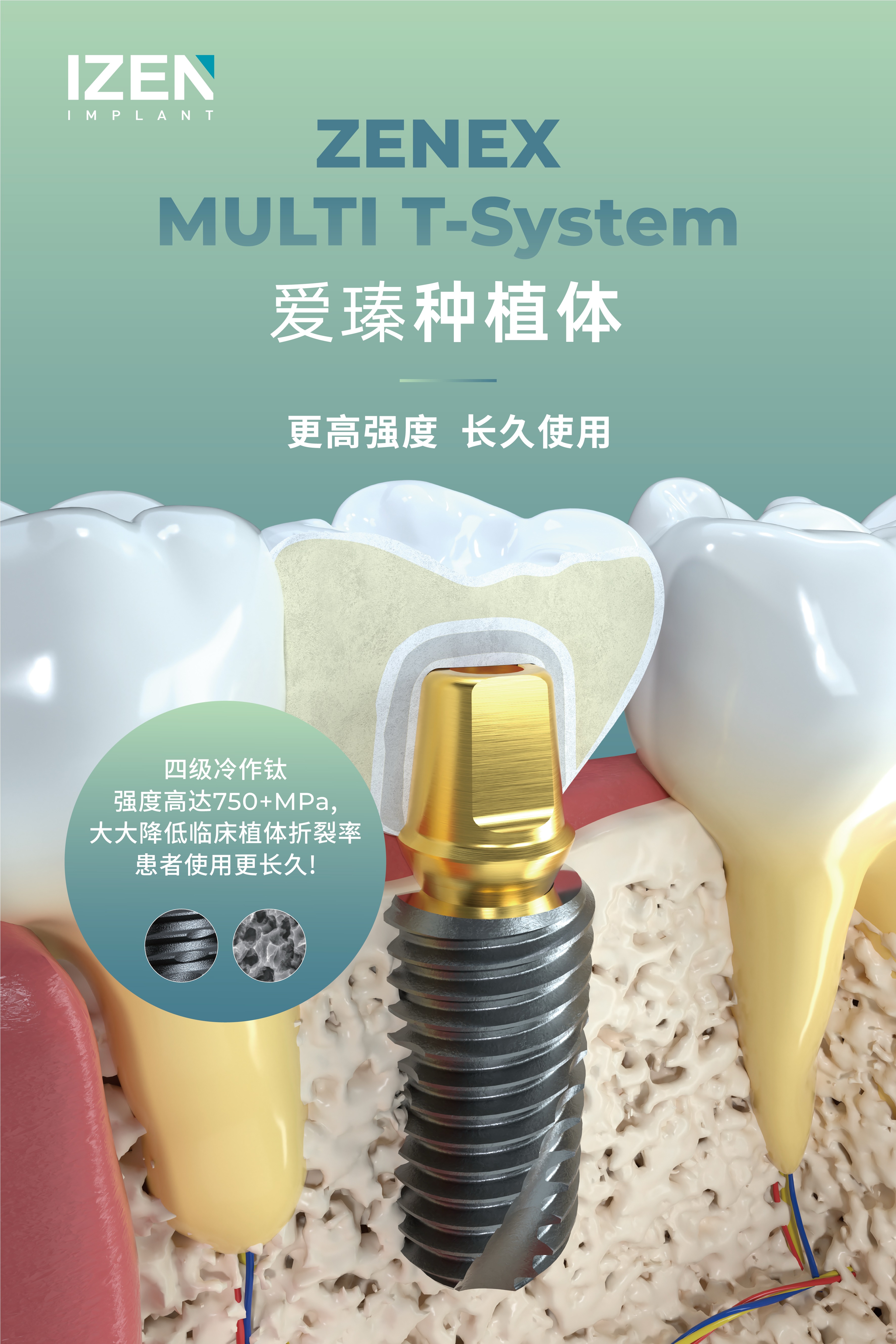 爱瑧IZEN（又名：爱臻）种植体进入中国，洁净技术引领韩系品牌再升级|界面新闻